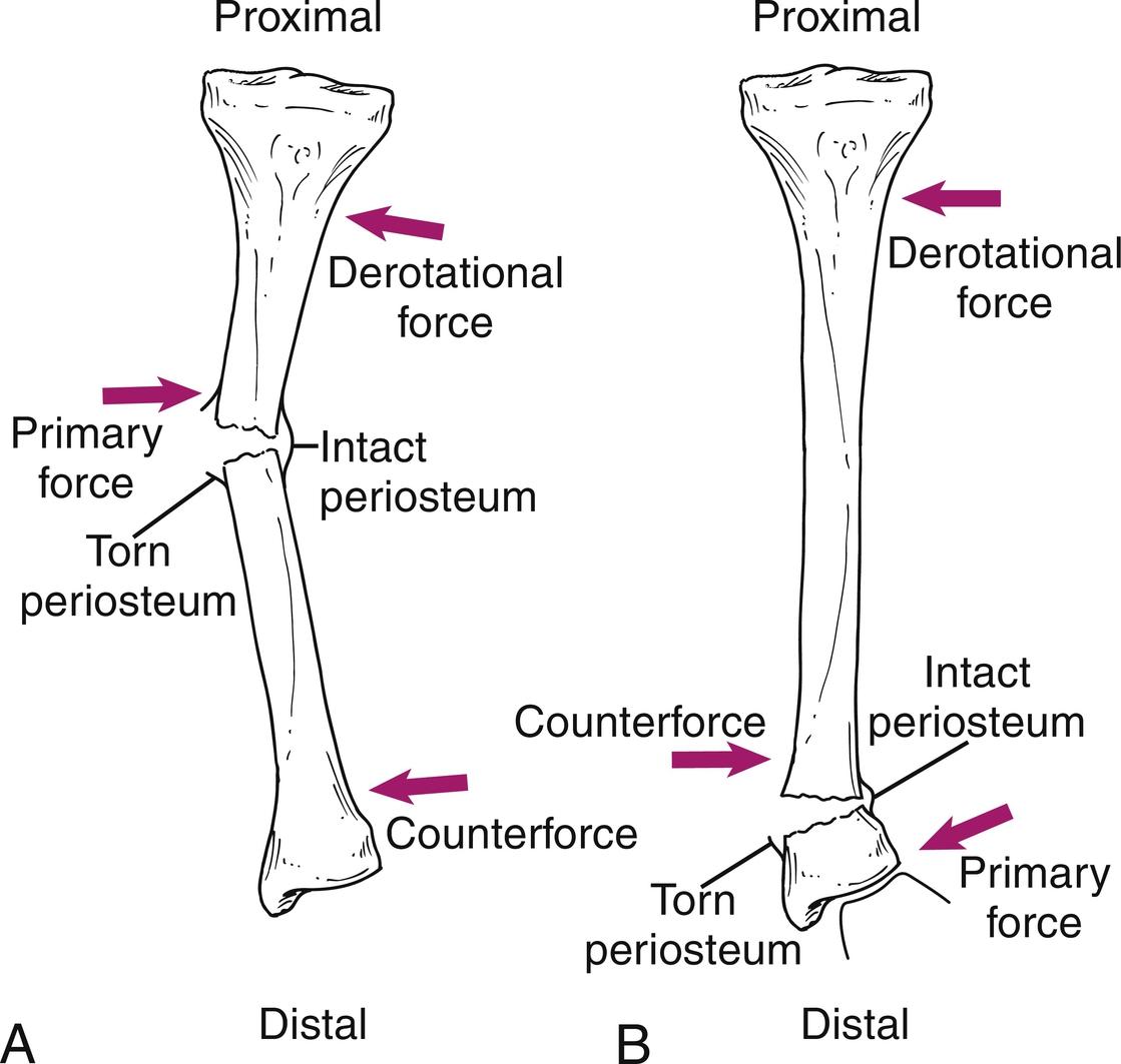 Basic Principles of Reduction Maneuvers - Clinical Tree