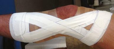 Basics of Taping and Orthotics - Clinical Tree