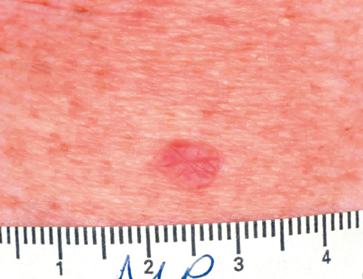Benign Epithelial Tumors And Proliferations Clinical Tree