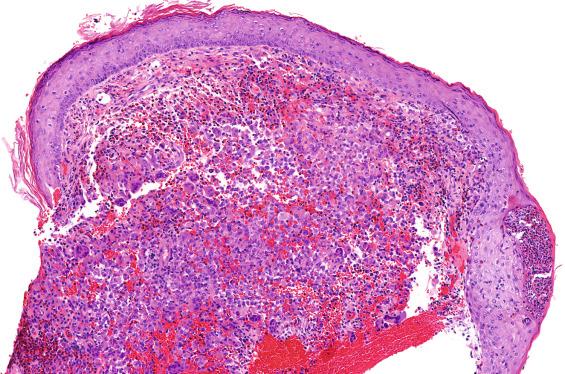 Benign Neoplasms of the Ear and Temporal Bone - Clinical Tree