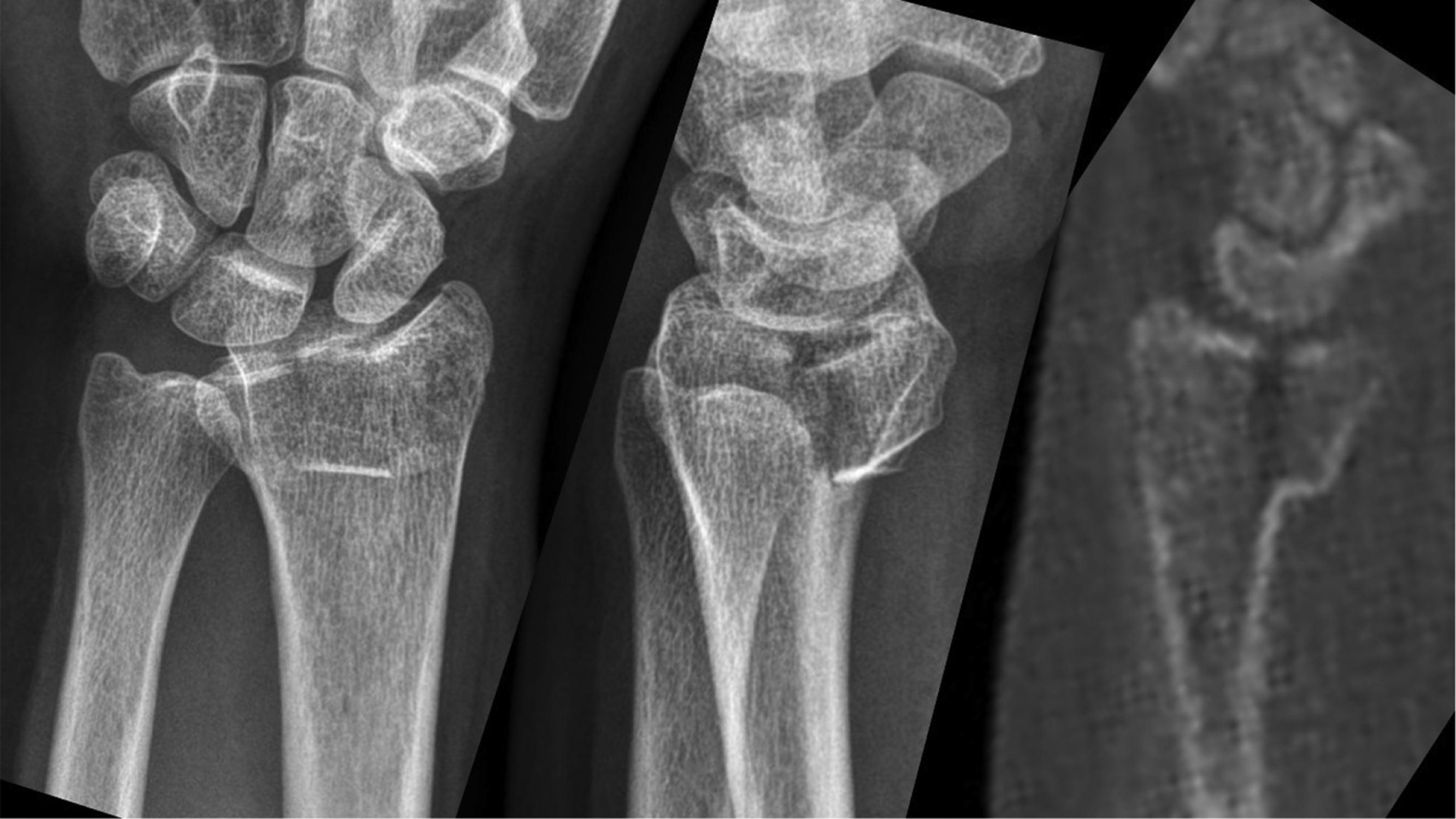 Biomechanics of Distal Radius Fractures - Clinical Tree