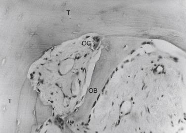 Bone Graft - Clinical Tree