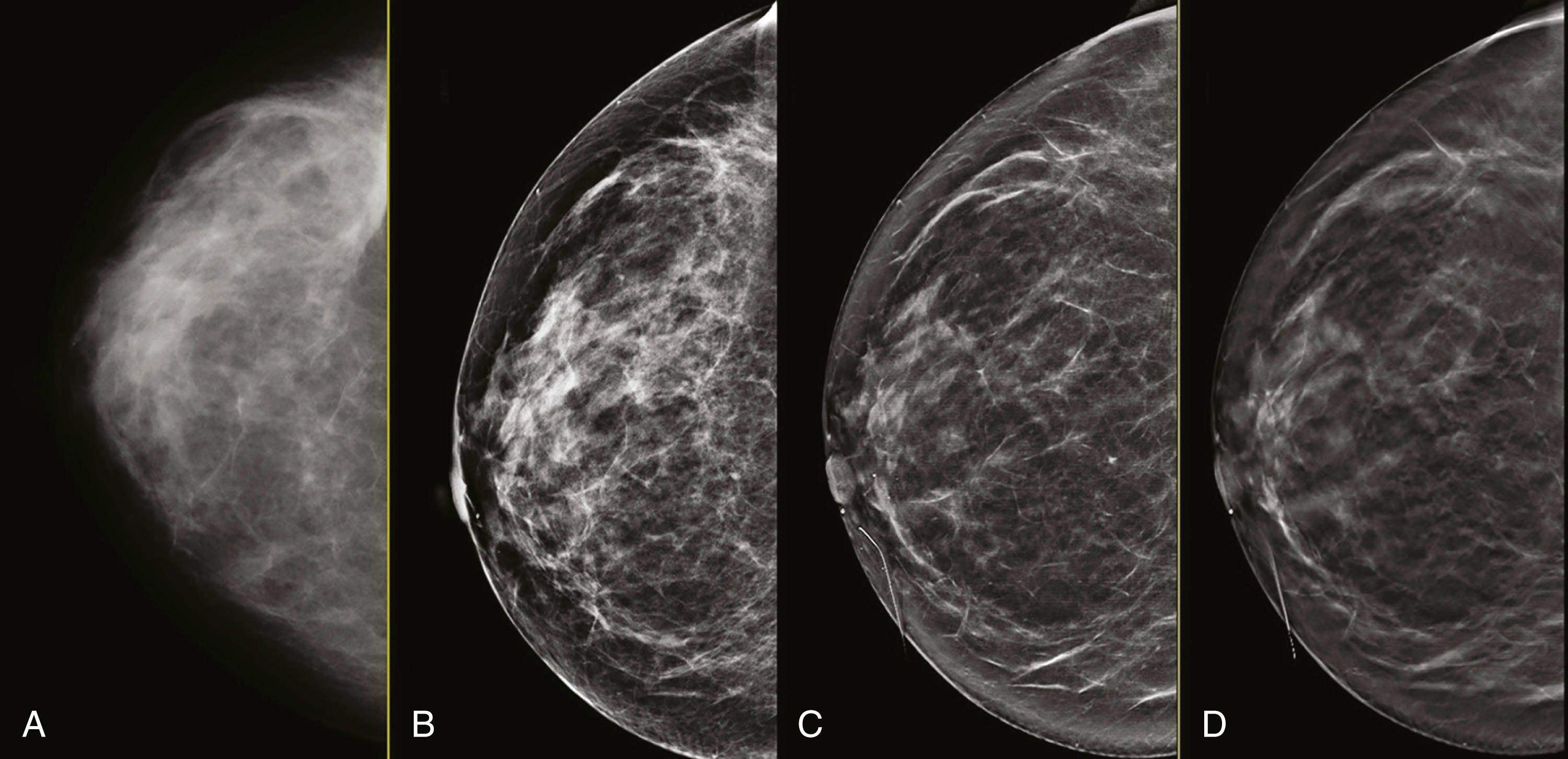 Breast Cancer Screening - Clinical Tree