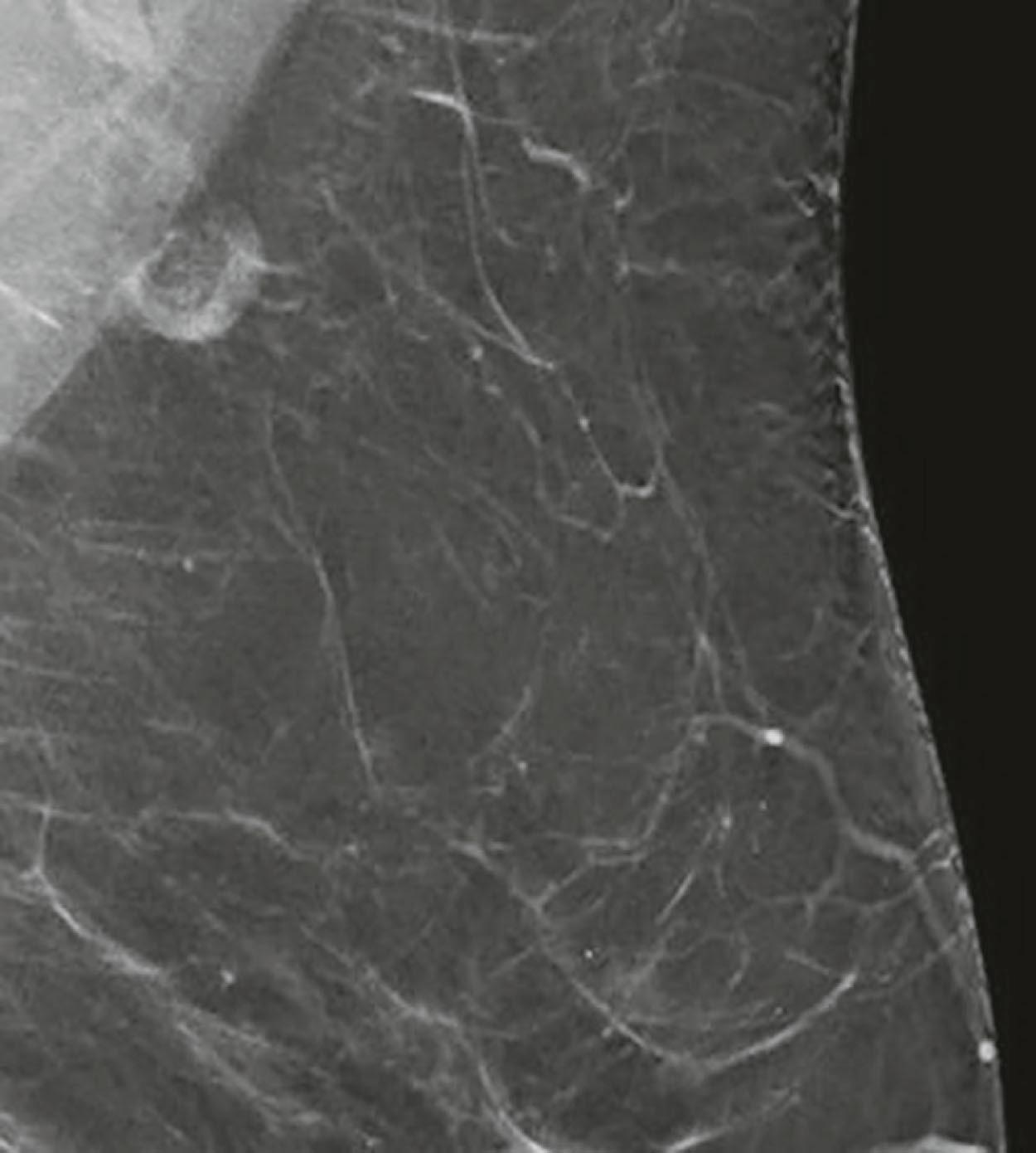 Breast Cancer Screening - Clinical Tree