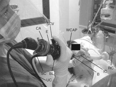 Bronchoscopy - Clinical Tree