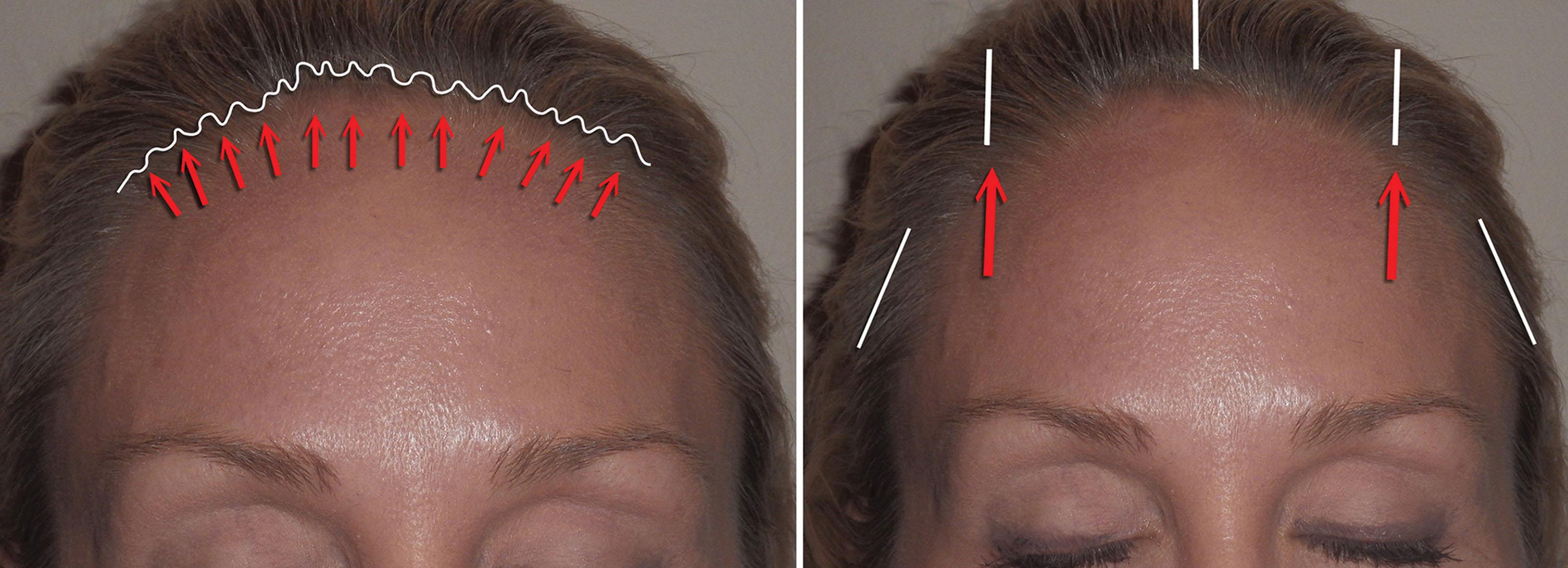Brow and Forehead Lift: Form, Function, and Evaluation - Clinical Tree