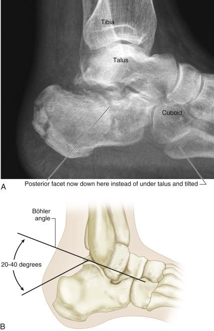 Calcaneus Fractures: Treatment Using Extensile Lateral Approach and ...