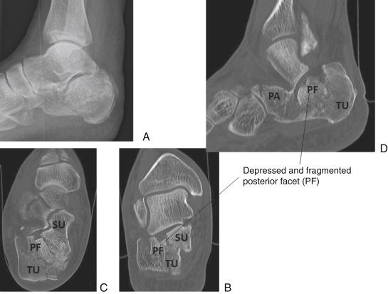 Calcaneus Fractures: Treatment Using Extensile Lateral Approach and ...