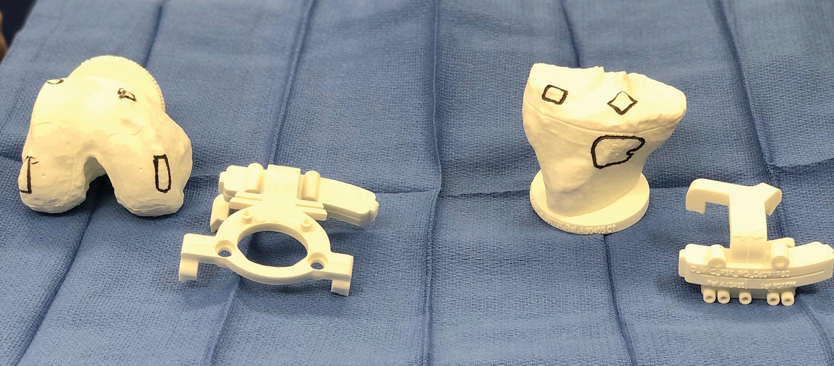 Calipered Kinematic Alignment Using Patient-Specific Instrumentation ...