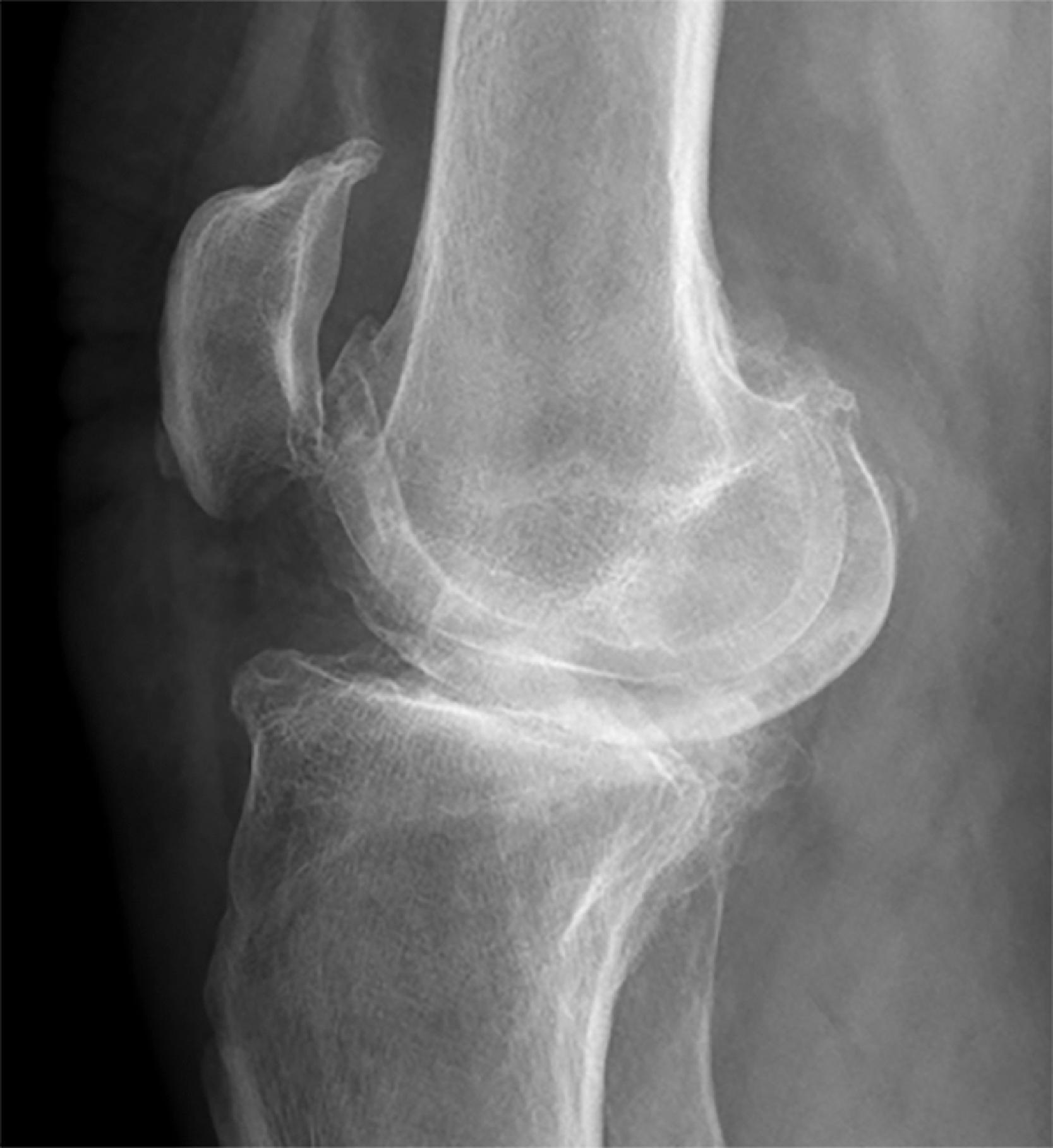 Calipered Kinematic Alignment With Navigation Instrumentation ...