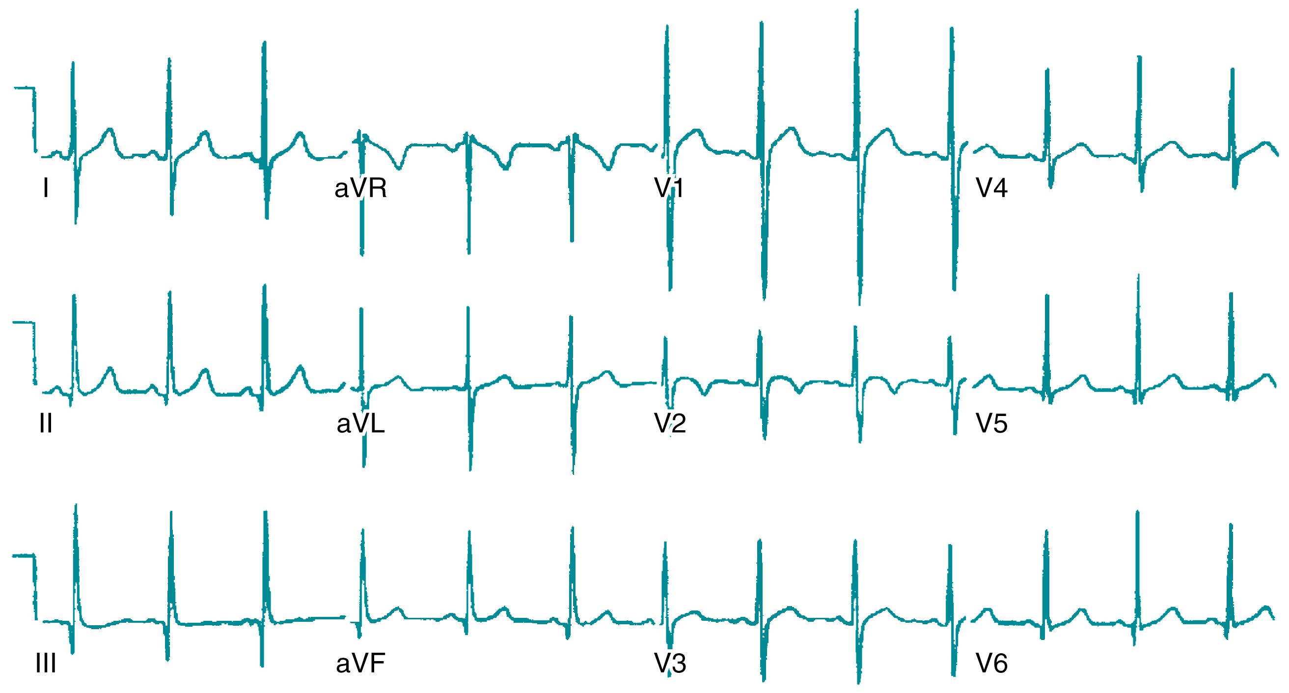 Cardiac Complications of Neuromuscular Disorders - Clinical Tree