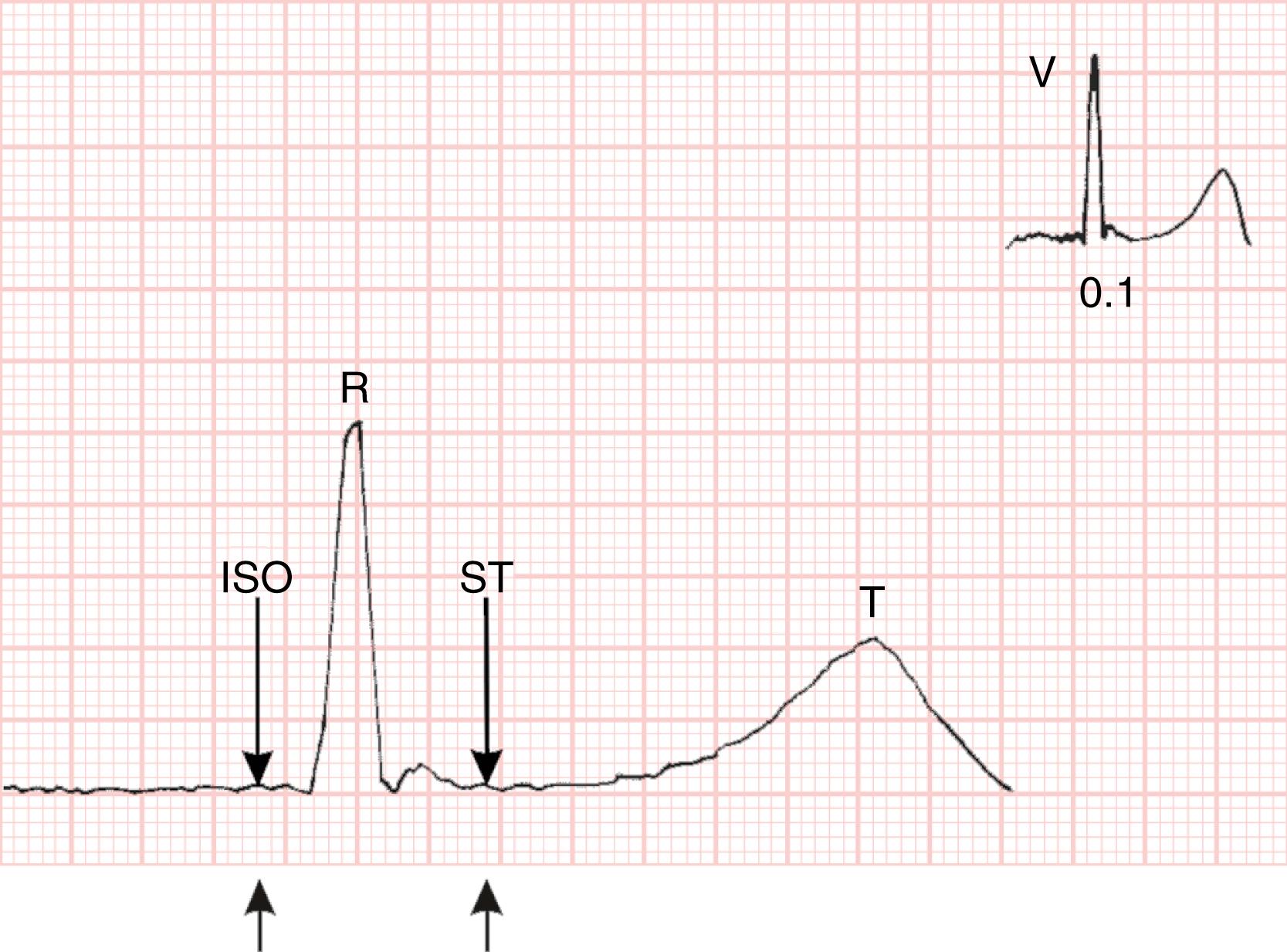 Cardiovascular Monitoring - Clinical Tree