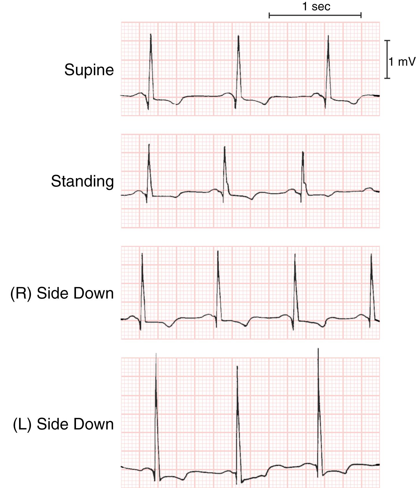 Cardiovascular Monitoring - Clinical Tree