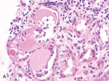 Cast nephropathy - Clinical Tree
