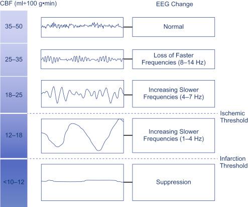 Cerebral Blood Flow Monitoring - Clinical Tree