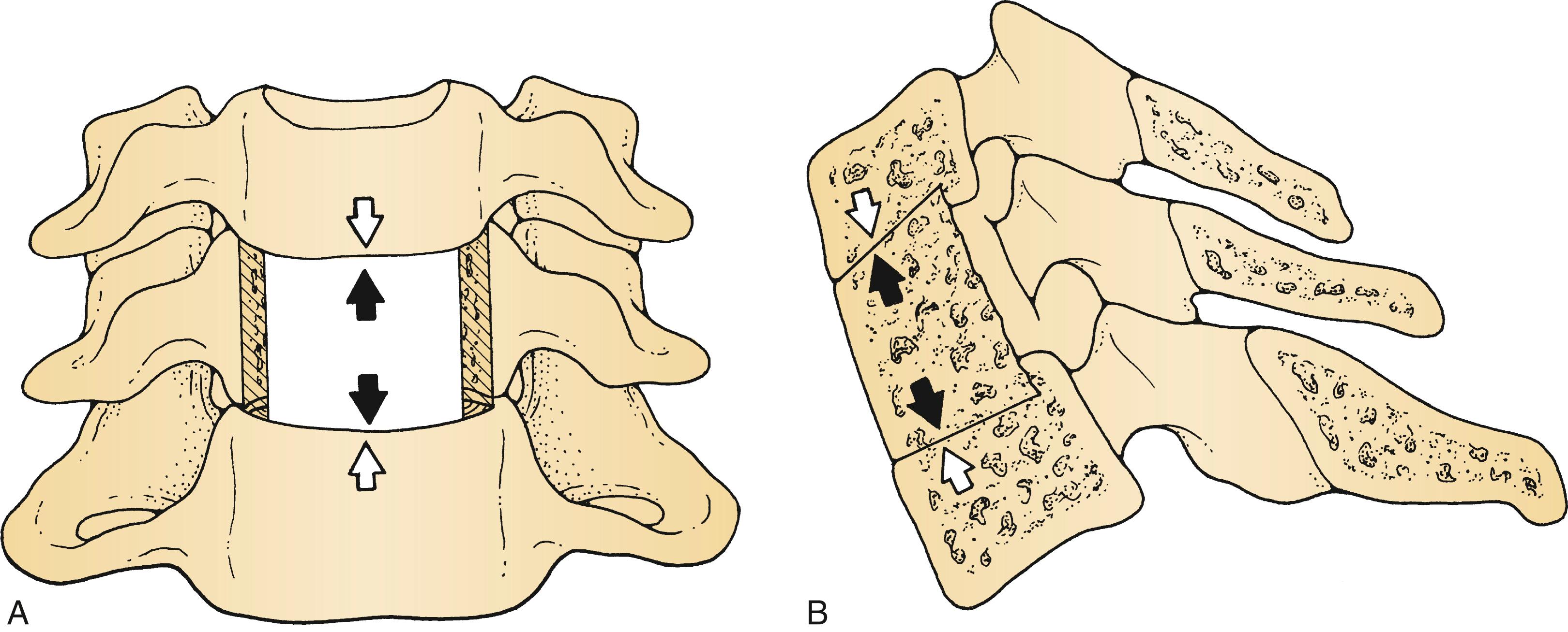 Cervical Spine Construct Design - Clinical Tree