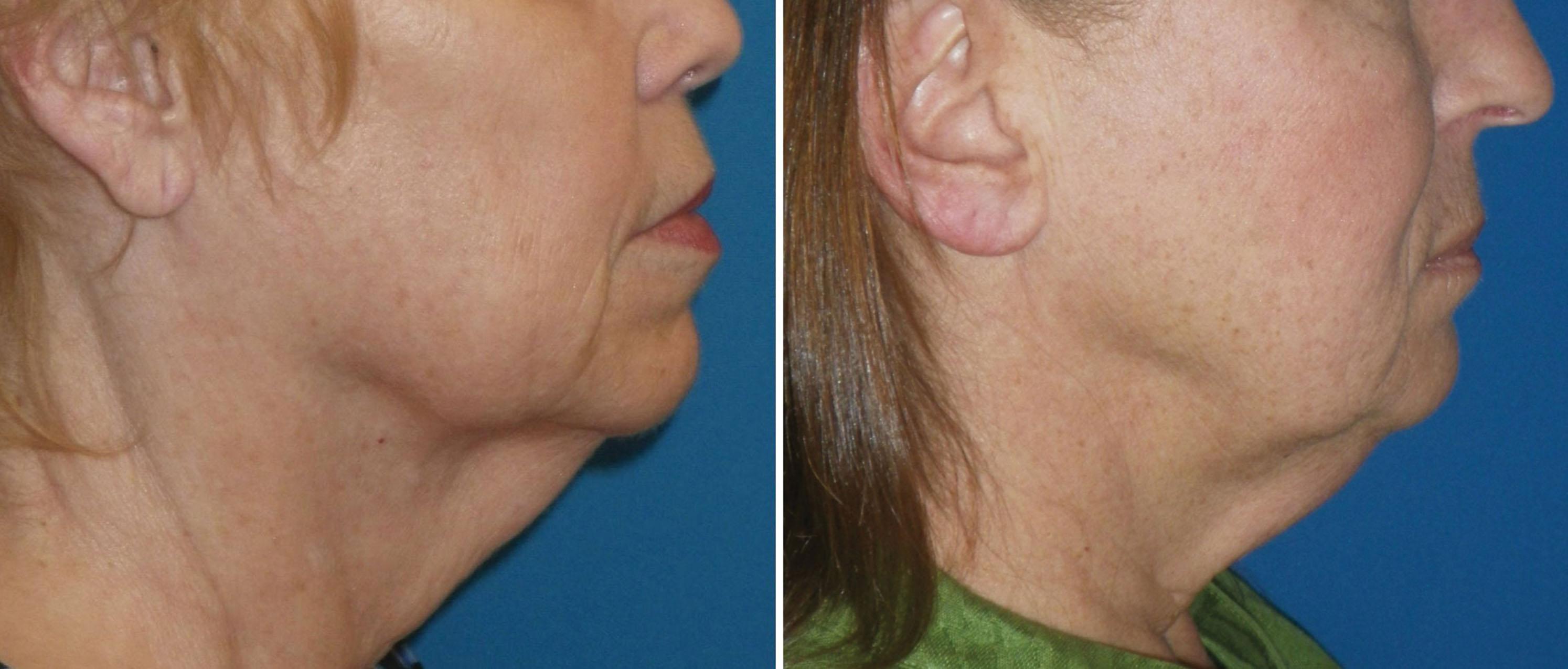 Cervicofacial Fat Reduction and Augmentation - Clinical Tree
