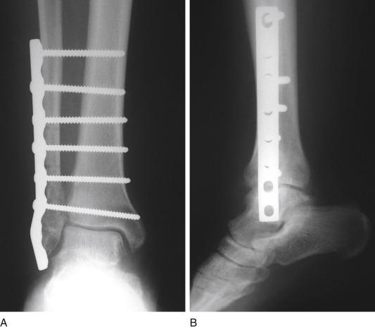 Charcot Ankle Fractures - Clinical Tree