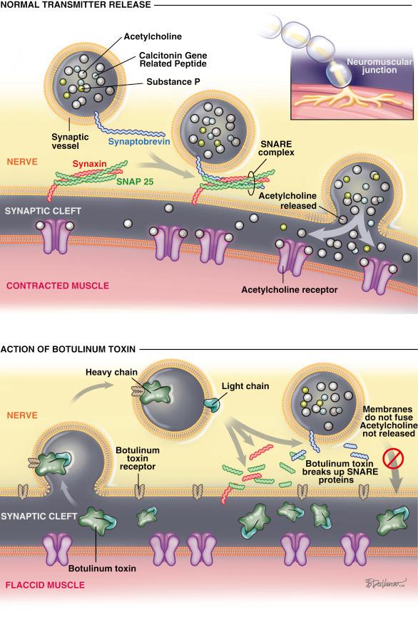Chemical Component Separation with Botox - Clinical Tree