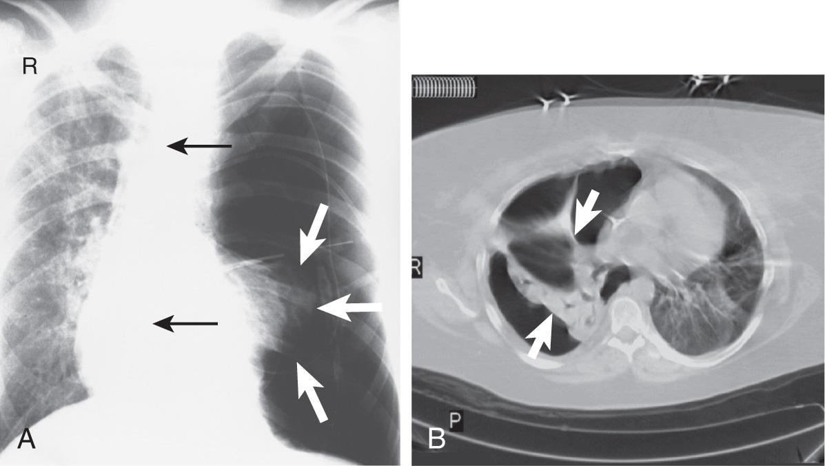 Chest x-ray - Clinical Tree