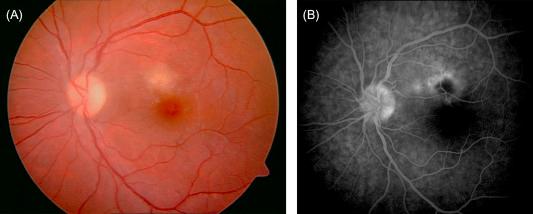 Chorioretinal Inflammatory Non-Infectious Diseases - Clinical Tree
