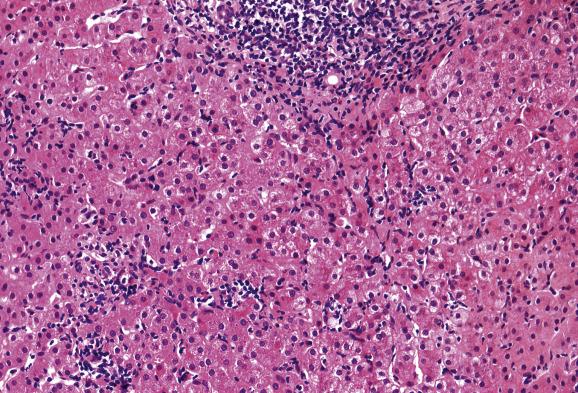 Chronic Hepatitis - Clinical Tree