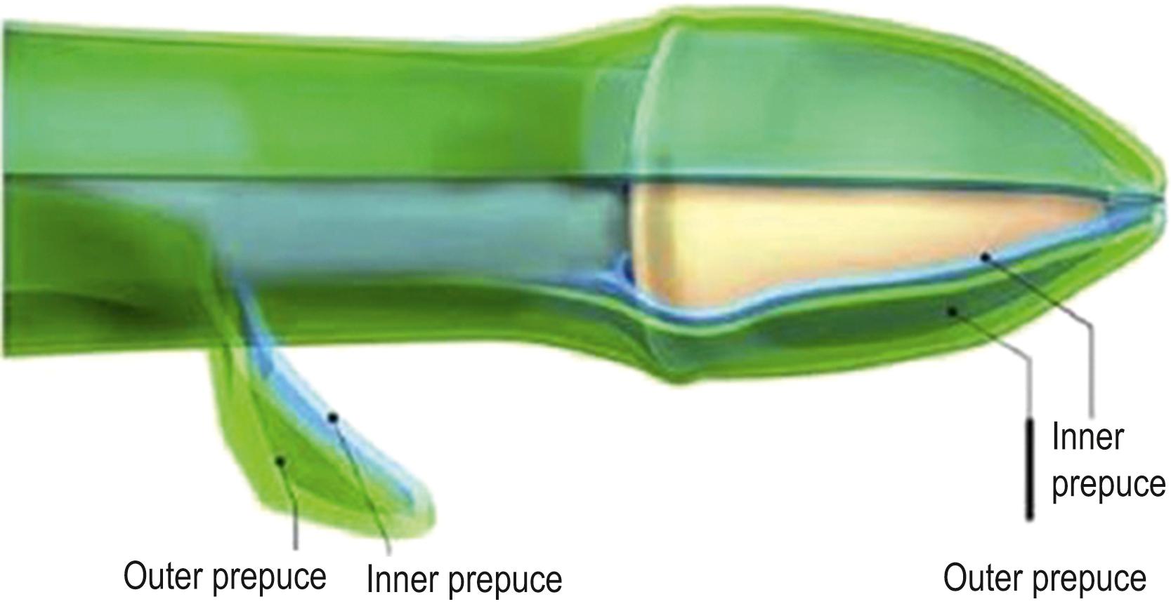 Circumcision - Clinical Tree