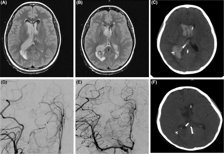 Clinical Aspects of Intraventricular Hemorrhage - Clinical Tree