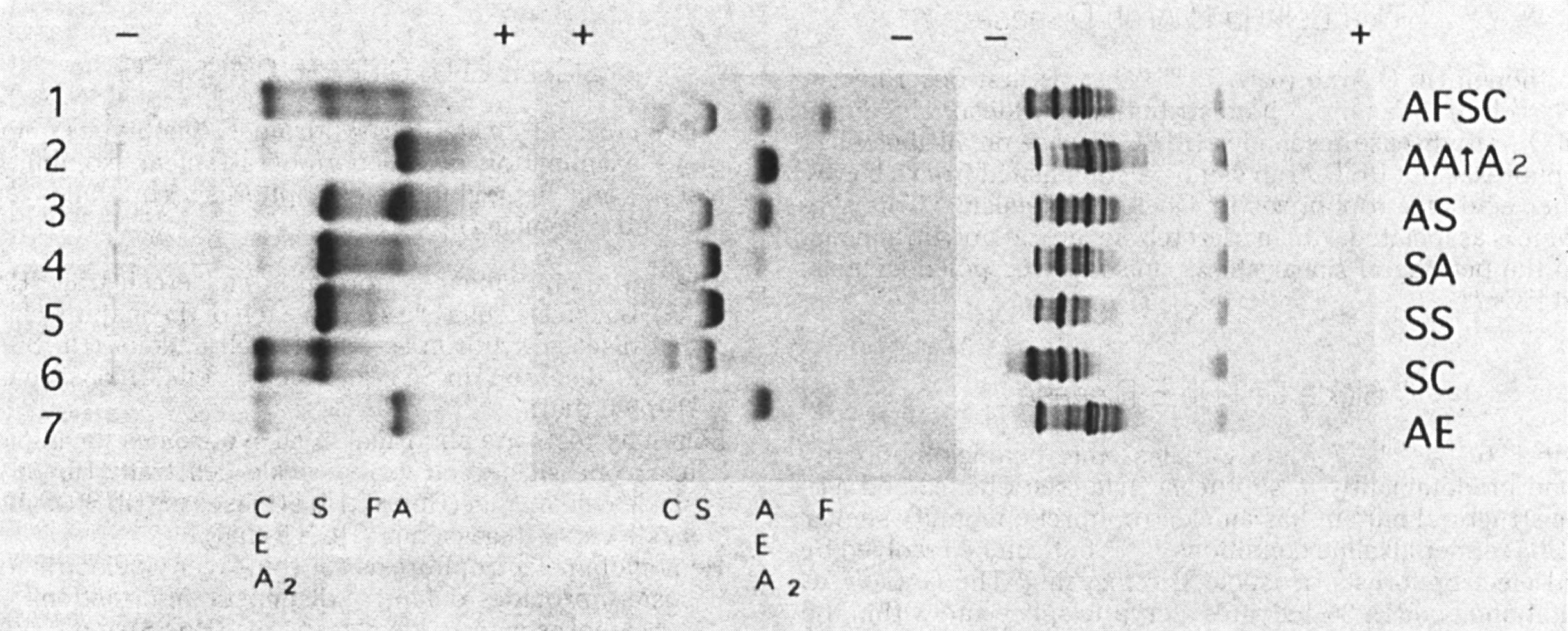 Clinical Aspects of Sickle Cell Disease - Clinical Tree