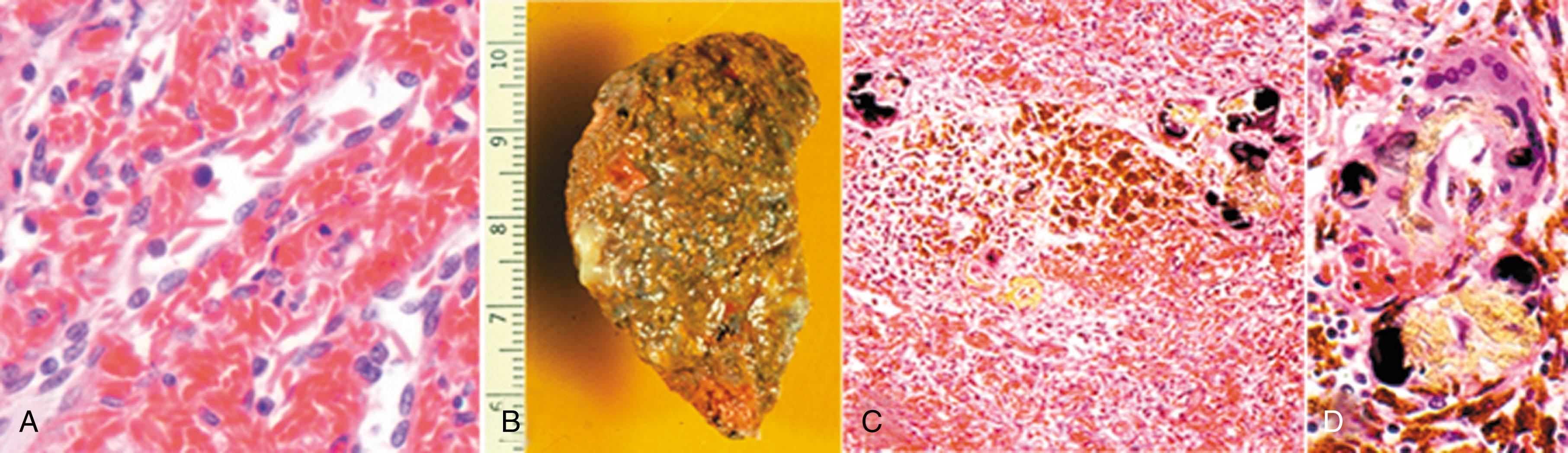 Clinical Aspects of Sickle Cell Disease - Clinical Tree