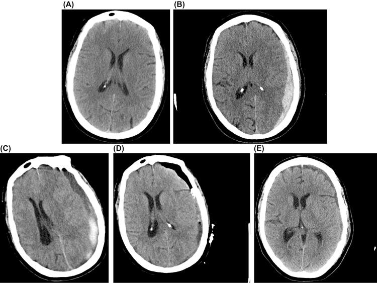 Clinical Aspects of Subdural Hemorrhage (SDH) - Clinical Tree
