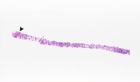 Collection, Processing, and Examination of Bone Marrow Specimens ...