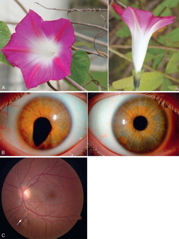 Coloboma - Clinical Tree