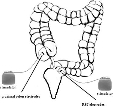 Colonic Electrical Stimulation for Constipation - Clinical Tree