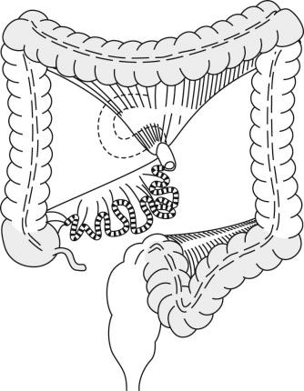 Colonoscopy - Clinical Tree