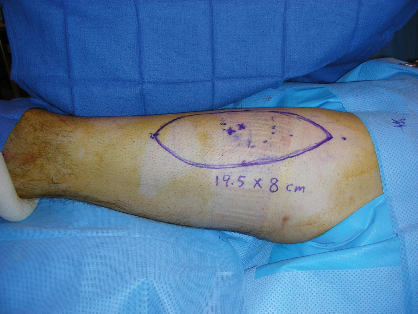 Complex Ankle Reconstruction - Clinical Tree