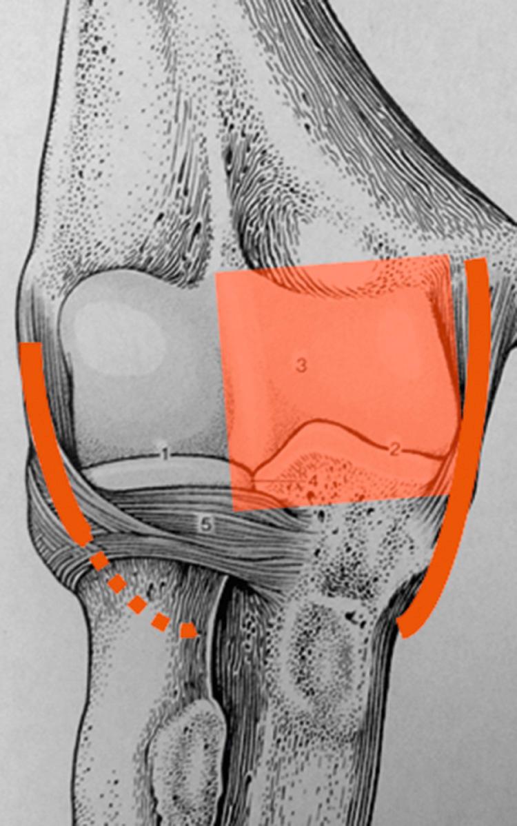 Complex Elbow Instability: General Principles - Clinical Tree