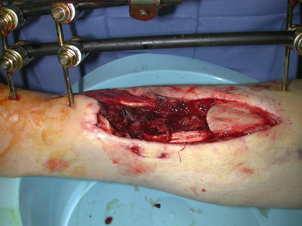 Complex Leg Reconstruction - Clinical Tree