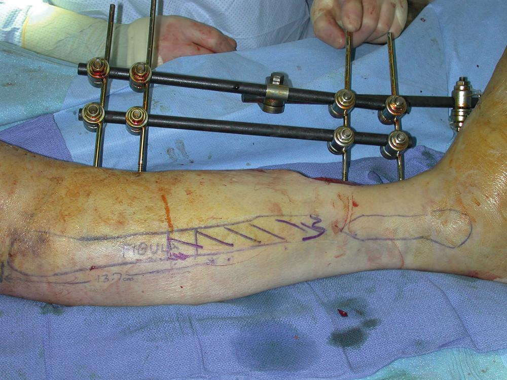 Complex Leg Reconstruction - Clinical Tree