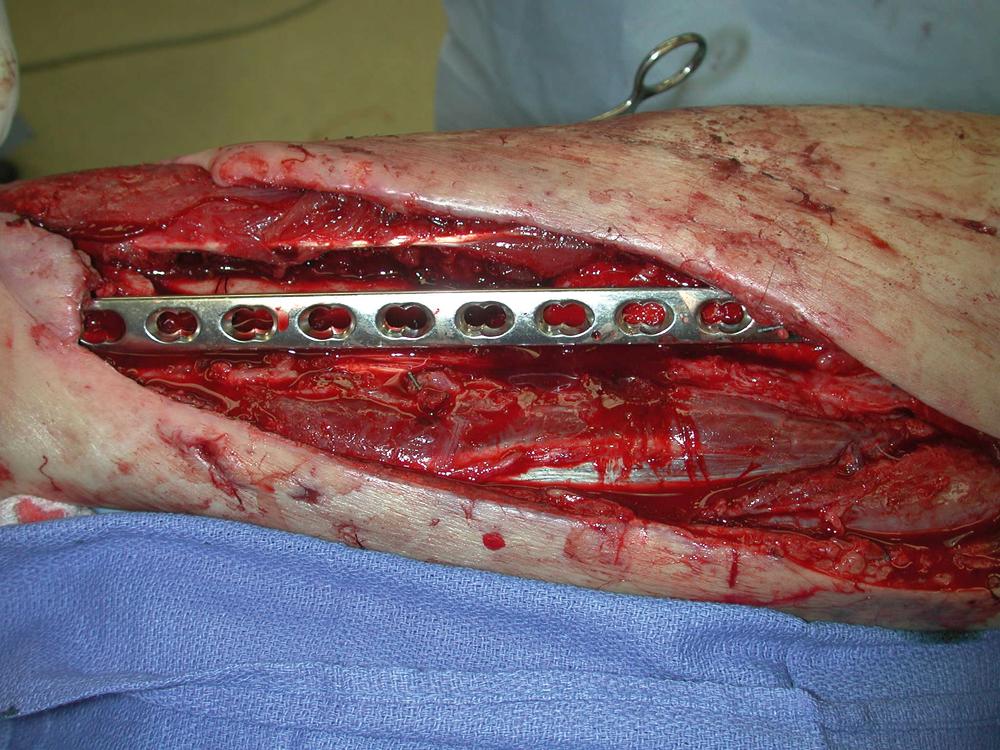 Complex Leg Reconstruction - Clinical Tree