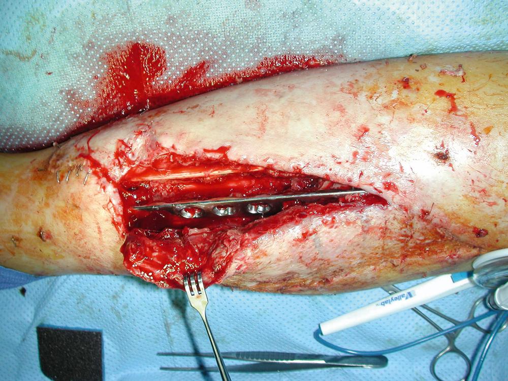 Complex Leg Reconstruction - Clinical Tree