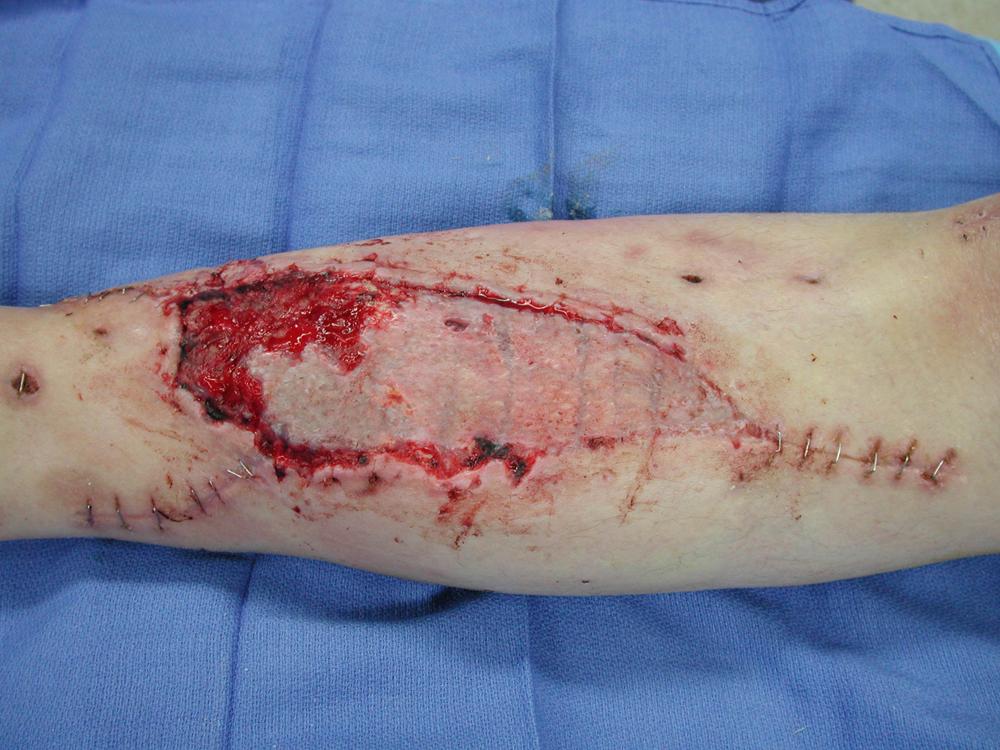 Complex Leg Reconstruction - Clinical Tree