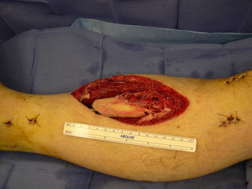Complex Leg Reconstruction - Clinical Tree