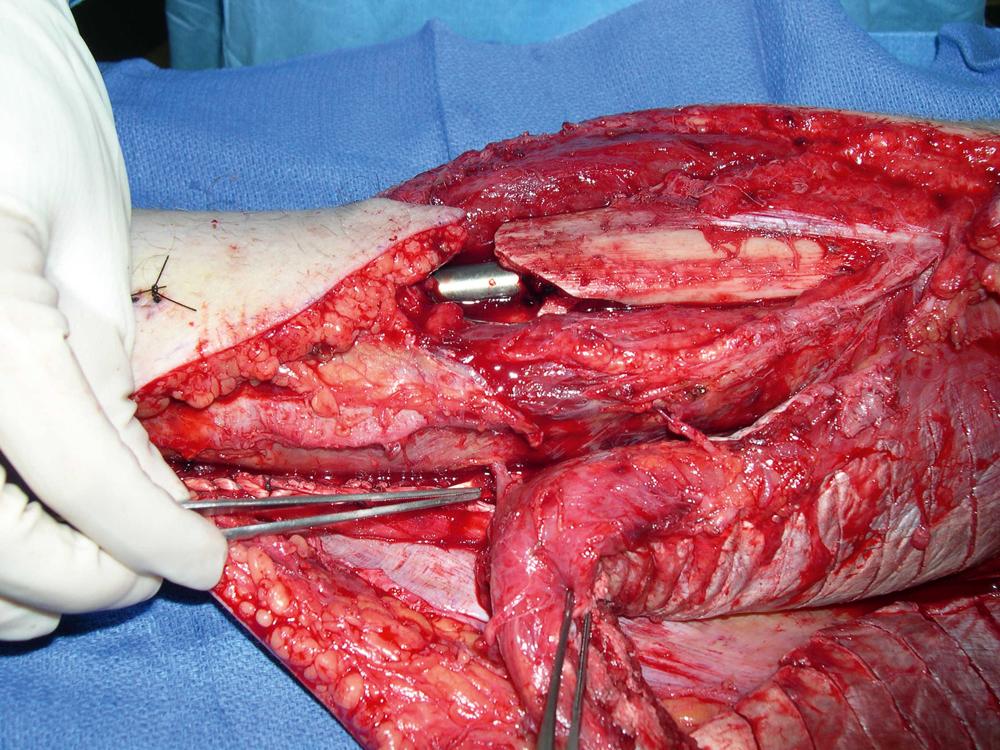 Complex Leg Reconstruction - Clinical Tree