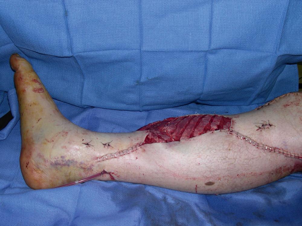 Complex Leg Reconstruction - Clinical Tree