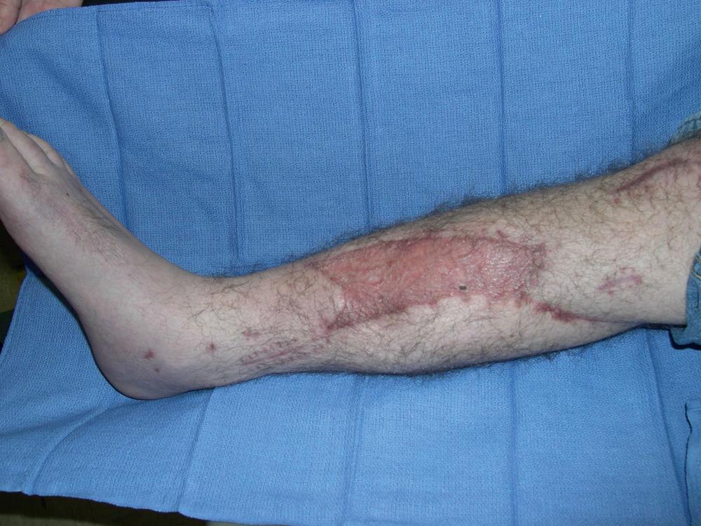 Complex Leg Reconstruction - Clinical Tree