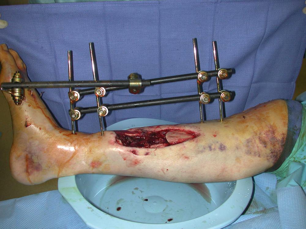 Complex Leg Reconstruction - Clinical Tree