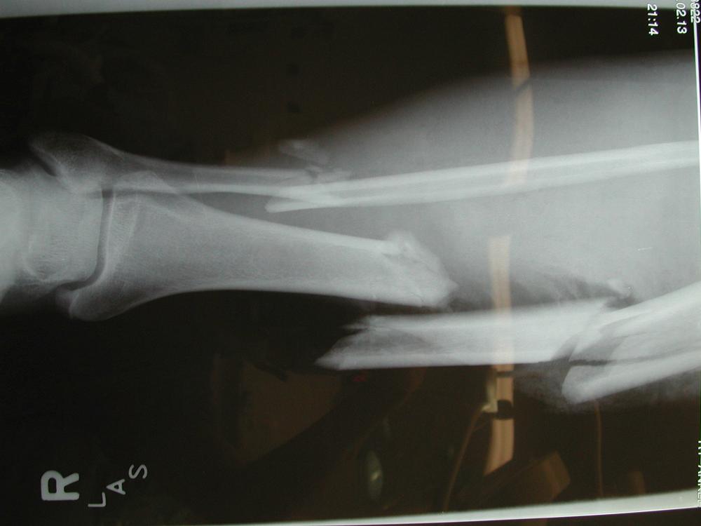 Complex Leg Reconstruction - Clinical Tree