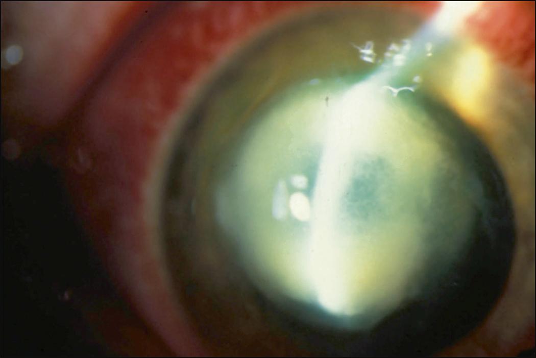 Complications of Contact Lens Wear - Clinical Tree