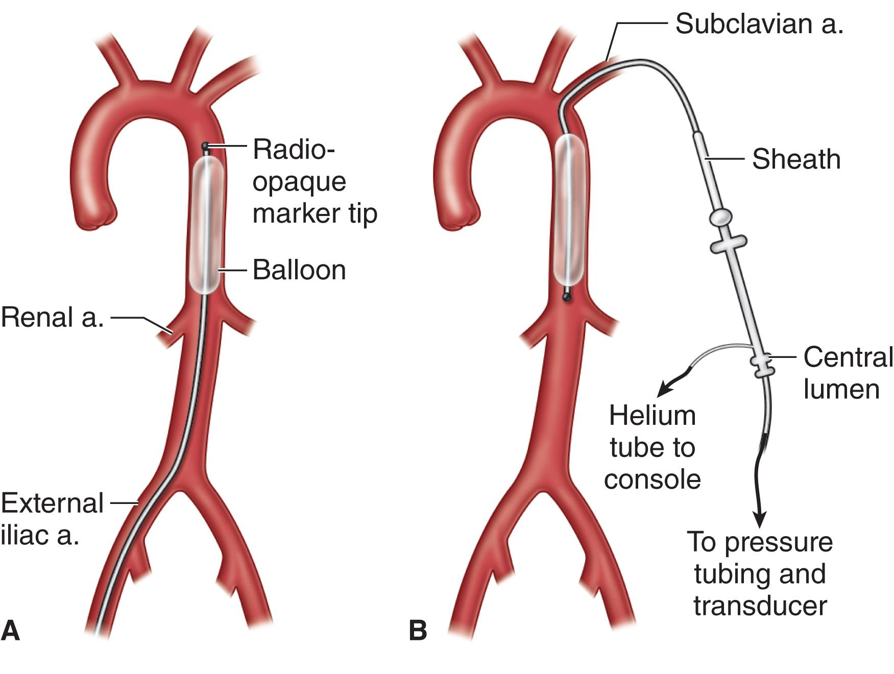Complications of ECMO and IABP - Clinical Tree